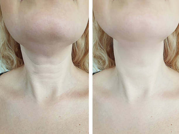 Neck Enhance: Fillers – DripGym